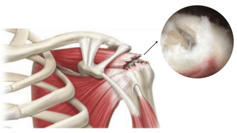 Manguito rotador | Clínica Dr. Marcio Rubin